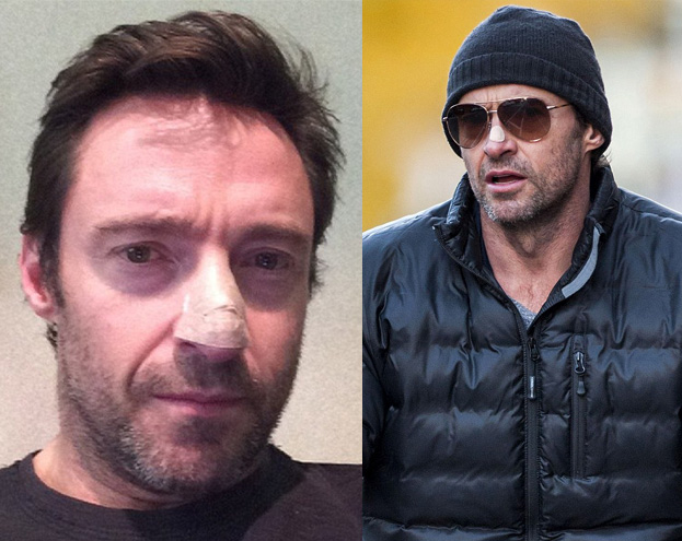 Hugh Jackman MIAŁ RAKA SKÓRY! - PUDELEK
